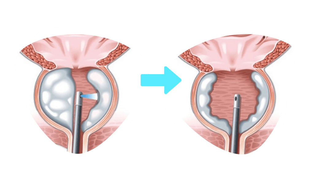 Holep Bph Therapy Eastern Suburb Urology