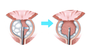HoLEP BPH Therapy - Eastern Suburb Urology